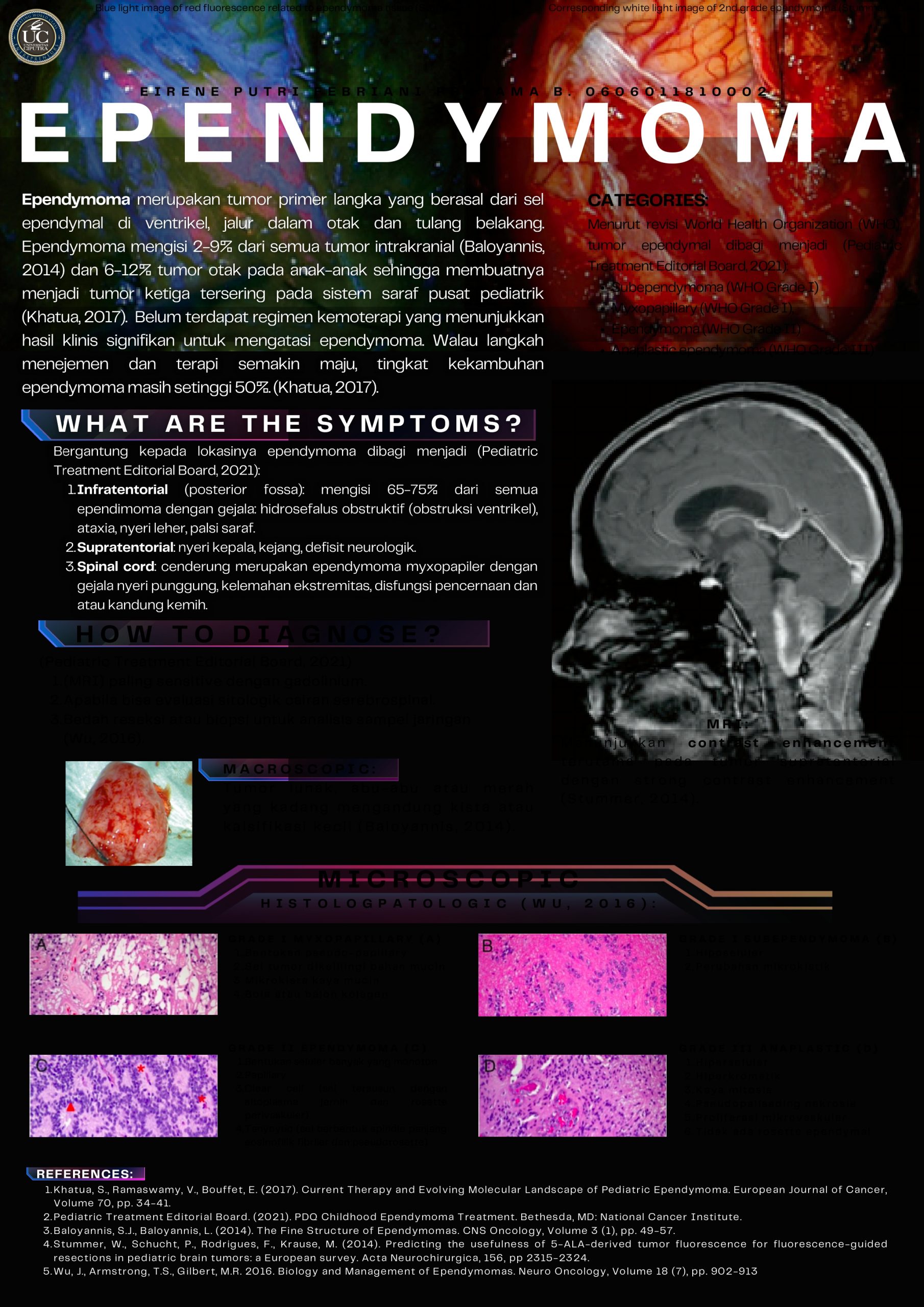 Ependymoma - Universitas Ciputra